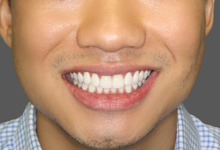 Veneers | Transform Your Smile with Maven Dental