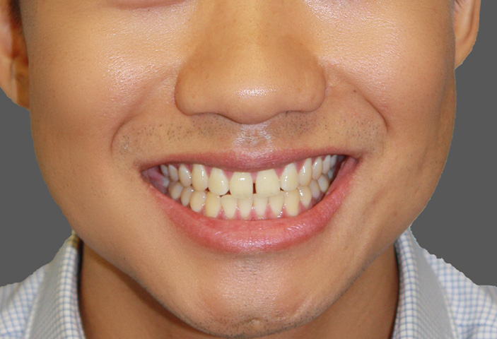 Veneers | Transform Your Smile with Maven Dental